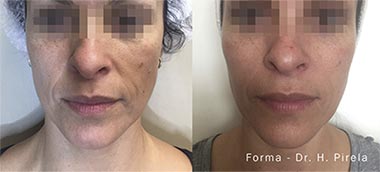 Benefits of Forma - Hollywood's Favorite Facial - Face and Body Laser