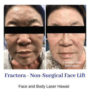 Fractora: Non-Surgical Face Lift with RF Microneedling