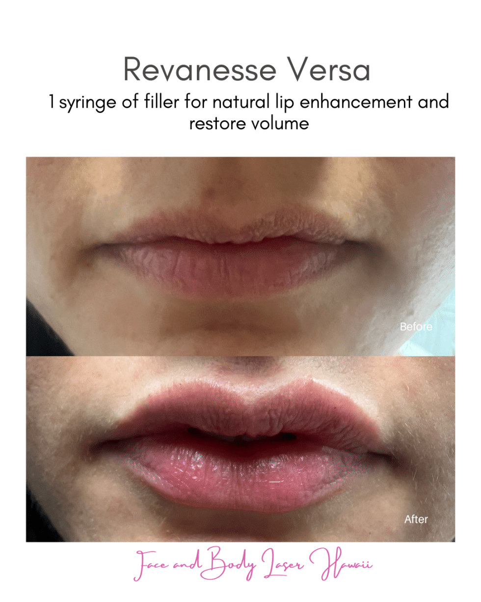 Summer Filler Special! $630/syringe - Face and Body Laser